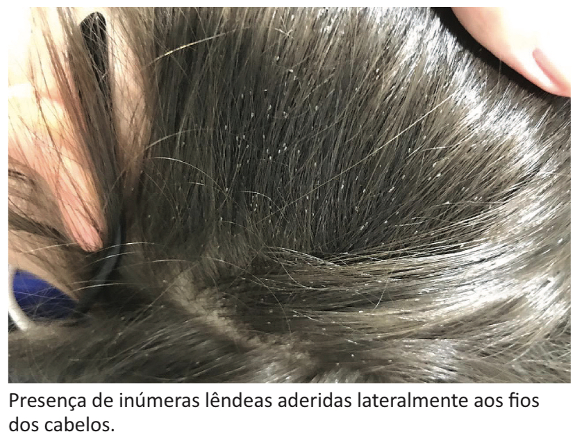 Como tratar piolho? | Clínica Gonçalves